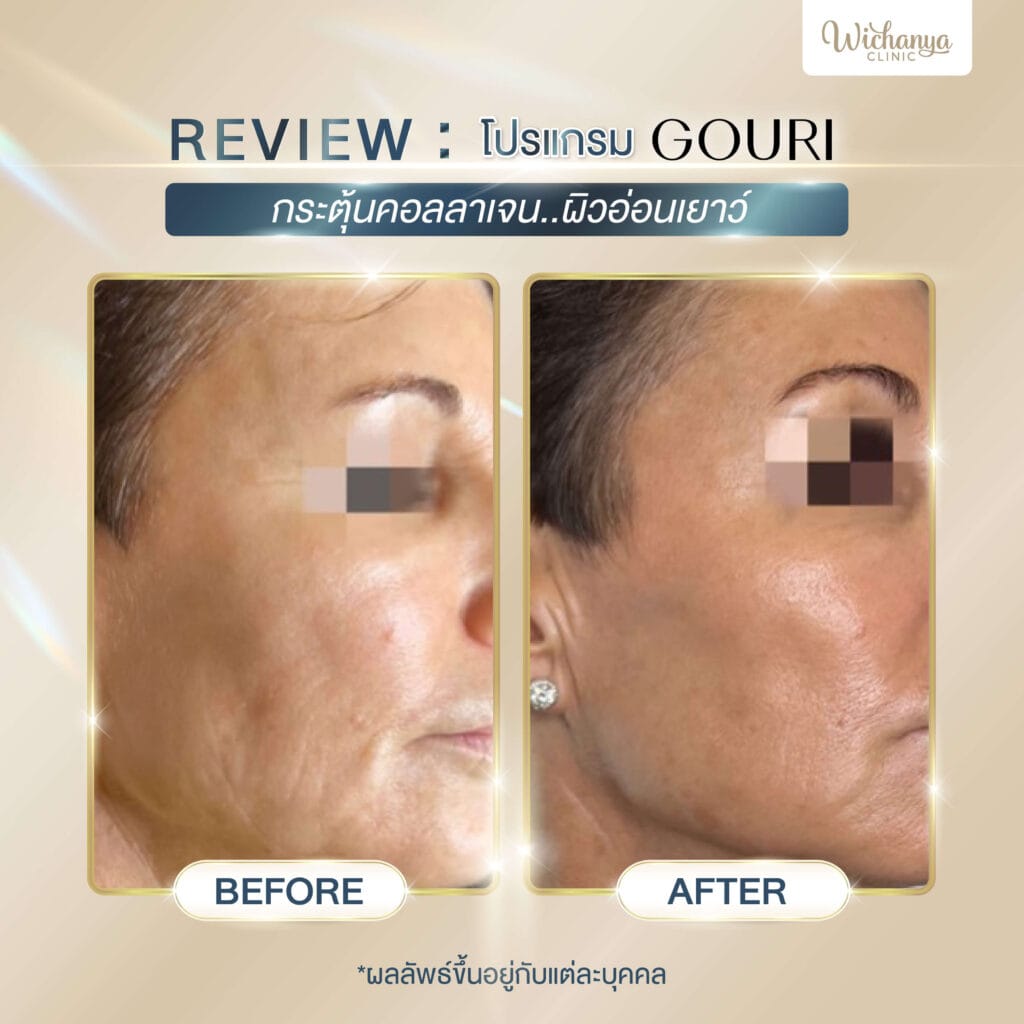 เจาะลึก Gouri ตัวช่วยกระตุ้นการสร้างคอลลาเจน แบบละเอียด