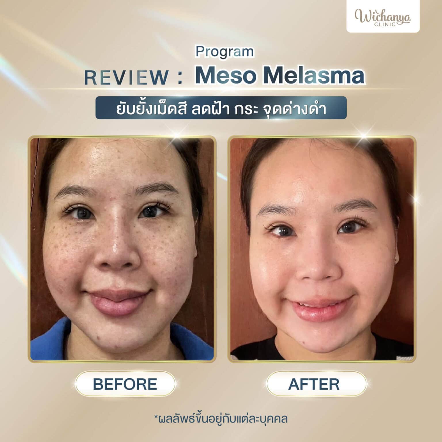 Meso Melasma ฉีดเมโสฝ้า แก้ปัญหาฝ้าที่กวนใจได้ผลลัพธ์ที่ชัดเจน